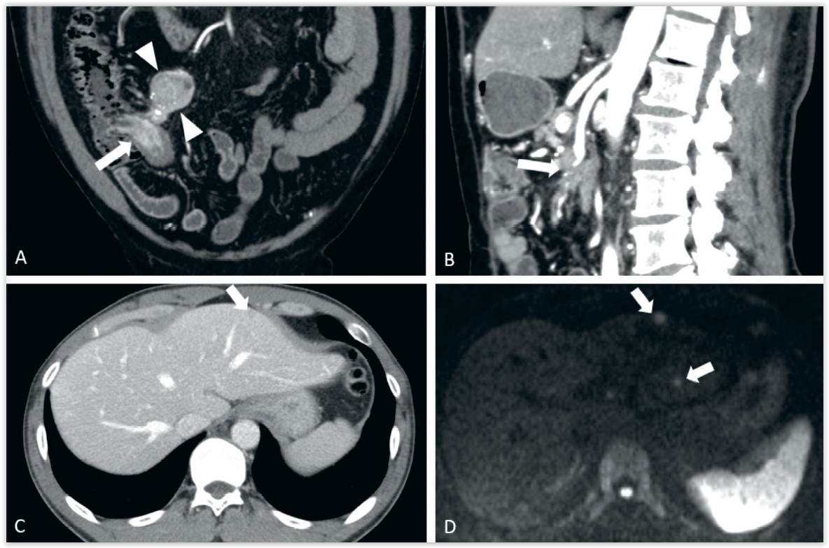 Ohutsuolen ja umpilisäkkeen neuroendokriiniset kasvaimet