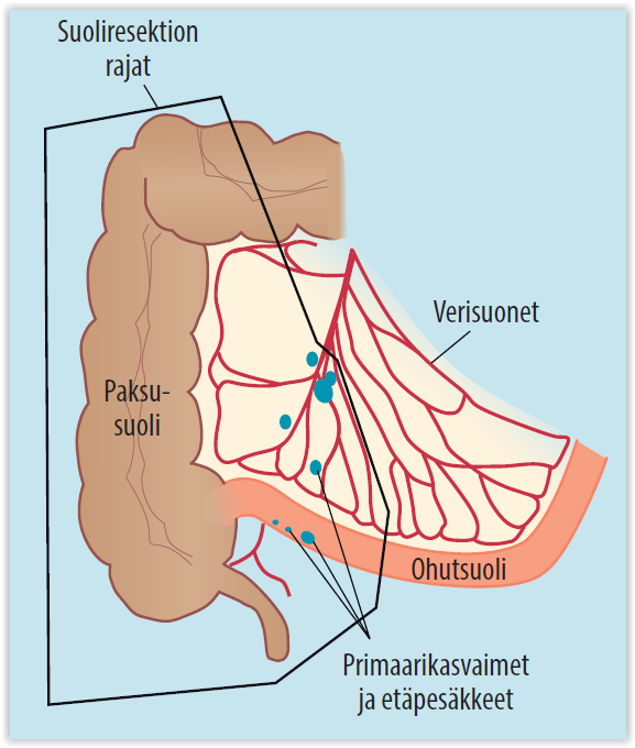 Ohutsuolen ja umpilisäkkeen neuroendokriiniset kasvaimet
