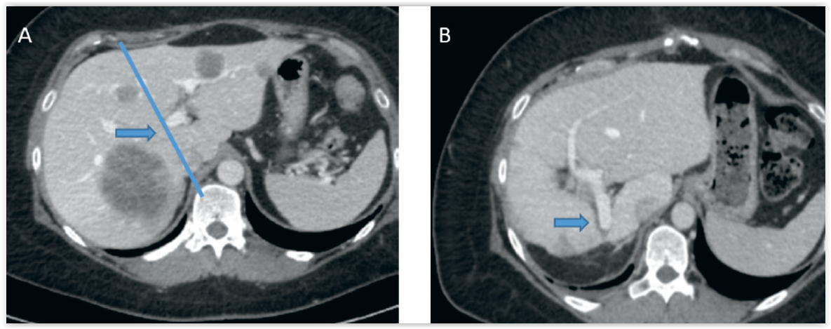 Ohutsuolen ja umpilisäkkeen neuroendokriiniset kasvaimet
