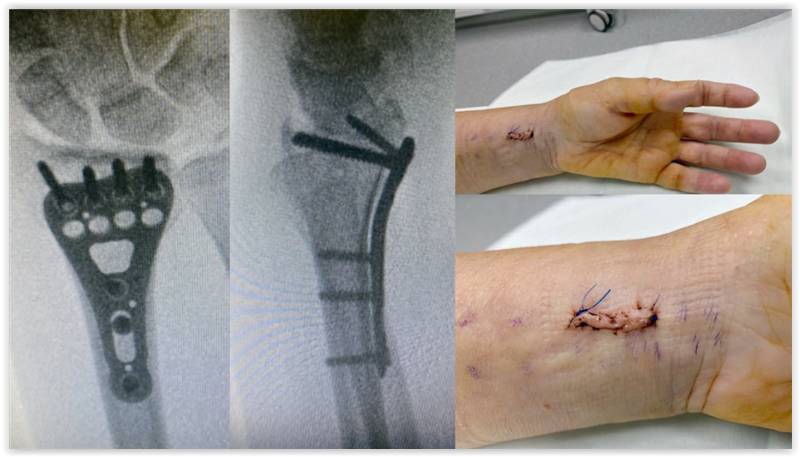 Työikäisen potilaan värttinäluun alaosan murtuman hoito