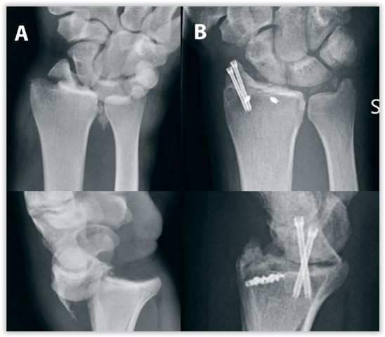 Työikäisen potilaan värttinäluun alaosan murtuman hoito