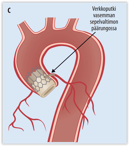 TAVI-potilaan sepelvaltimotaudin hoito