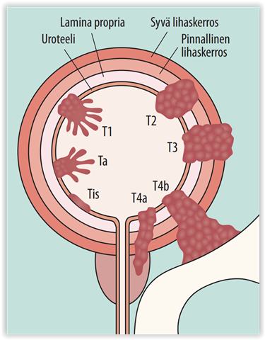 Virtsarakkosyövän hoito