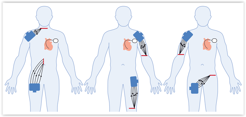 Tahdistinpotilas leikkauksessa tai muussa toimenpiteessä