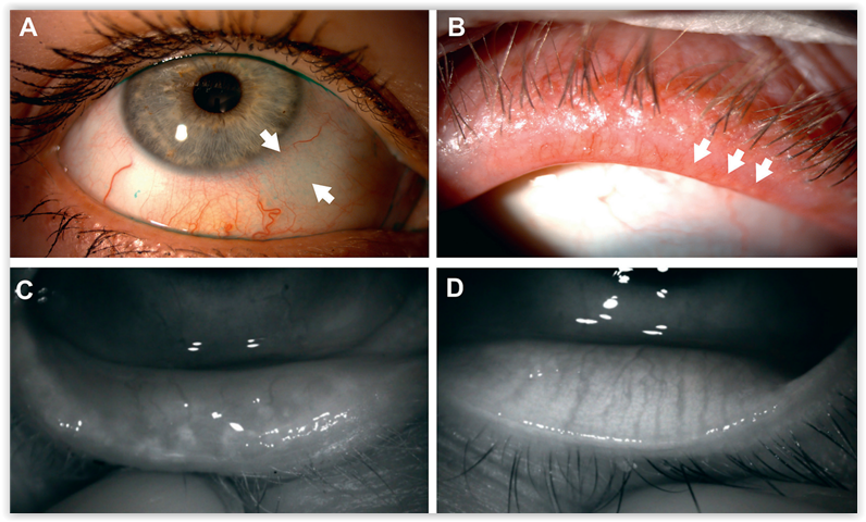 Monimuotoinen kuivasilmäisyys