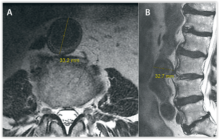 Sattumalöydökset lannerangan magneettikuvauksessa