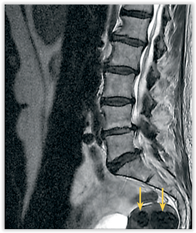 Sattumalöydökset lannerangan magneettikuvauksessa