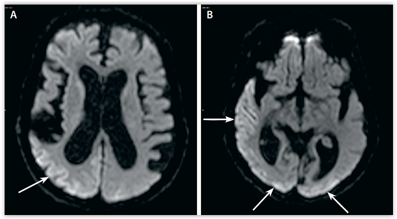 Creutzfeldt-Jakobin tauti dementian aiheuttajana - harvinainen mutta ...