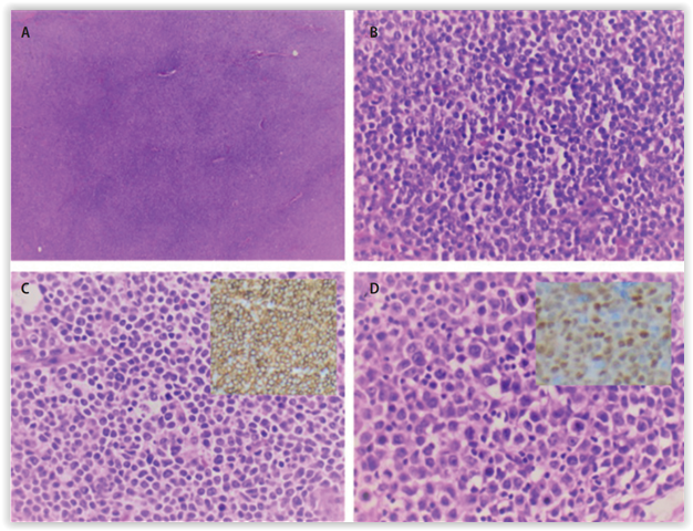 Lymfoomien patologisanatominen diagnostiikka