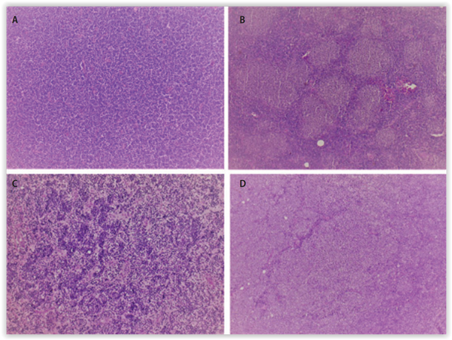Lymfoomien patologisanatominen diagnostiikka