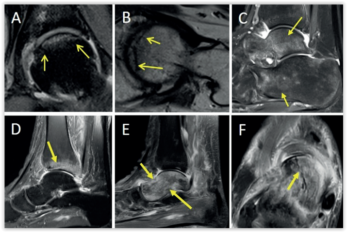 Tunnistatko patologisen rasitusmurtuman?