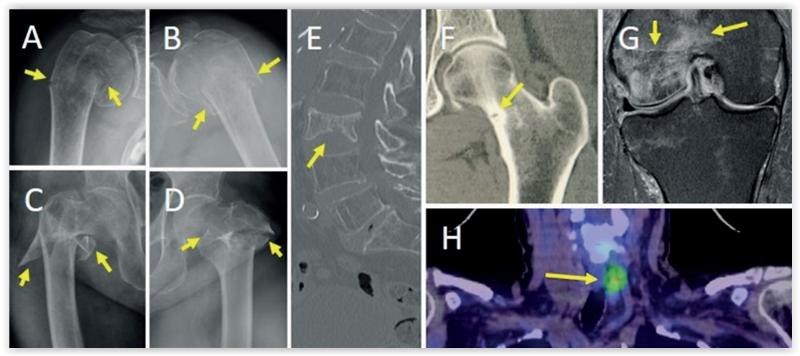 Tunnistatko patologisen rasitusmurtuman?