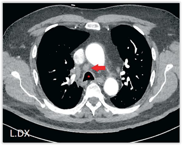 Keuhkoembolia sattumalöydöksenä keuhkoputkien kaikutähystyksessä