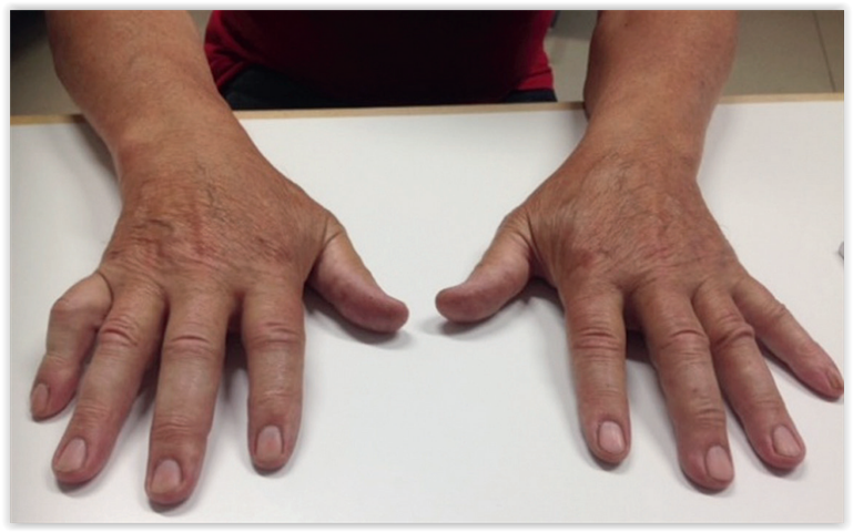 Miksi ikämiehen sormet puutuivat?