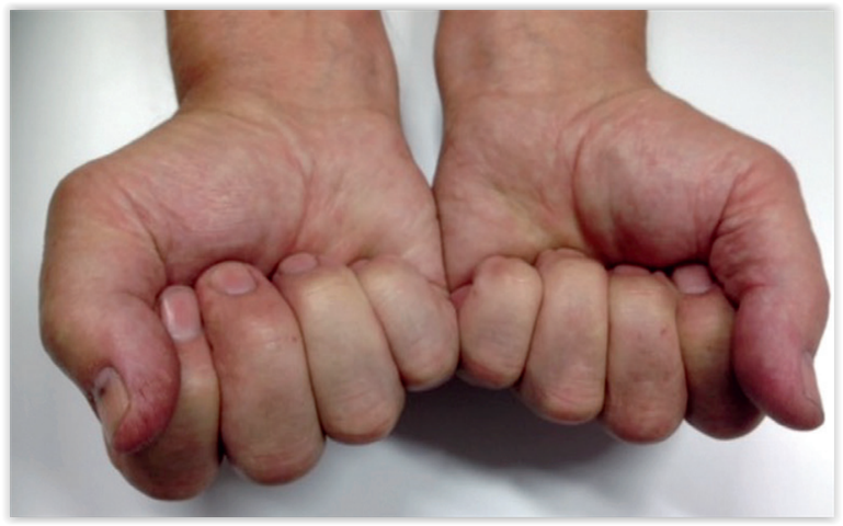 Miksi ikämiehen sormet puutuivat?