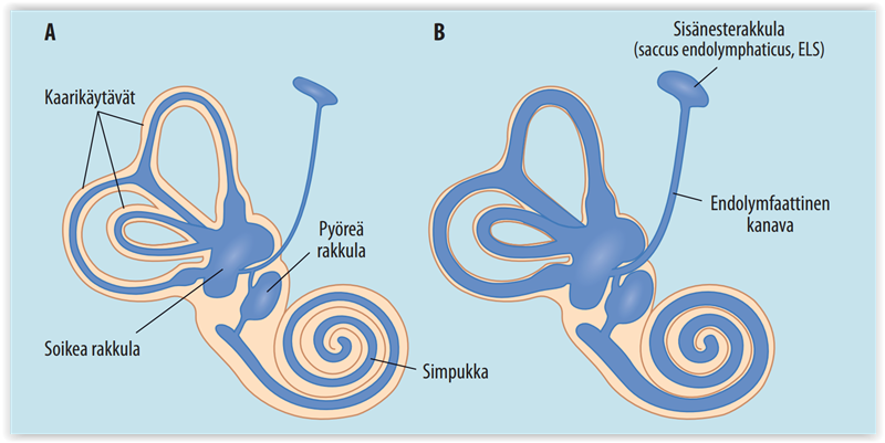 Meniérèn tauti pysyy hoidollisena haasteena