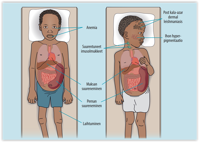 Viskeraalinen leishmaniaasi tunnistamattomana tappavana tautina