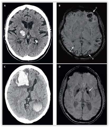 Valtimotautien ehkäisy aivoverenvuodon jälkeen
