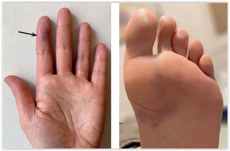 Achenbachin oireyhtymä voi esiintyä myös jalkapohjassa