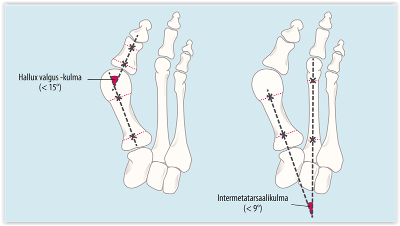 Hallux valgus - paljon enemmän kuin pelkkä liikavarvas
