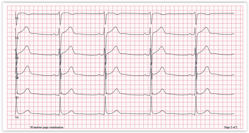EKG-tulkinnan kompastuskivet