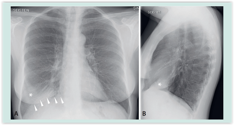 Etsi keuhkokuvasta kovia todisteita