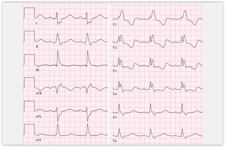 Haarakatkos EKG:ssä - milloin konsultoin erikoissairaanhoitoa?