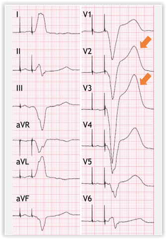 Sydänlihaksen iskemia ja haarakatkos - miten tunnistan hätätilanteet?