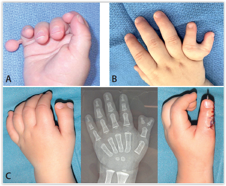 Lasten synnynnäiset yläraajapoikkeavuudet