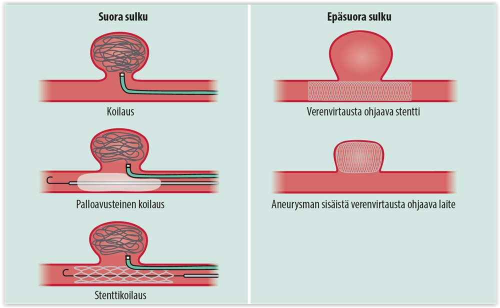 Potilasvalinta aivovaltimoiden endovaskulaarihoitoihin