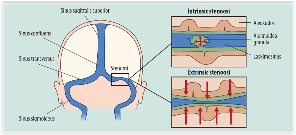 Aivolaskimosinuksen stentti idiopaattisen intrakraniaalisen ...
