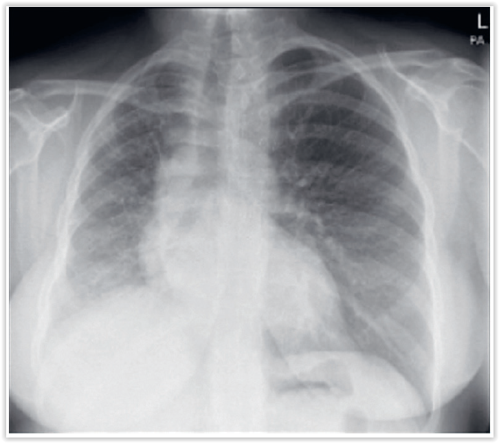 Toispuolinen keuhkolaskimoatresia