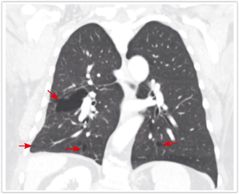 Keuhkot reikiä täynnä