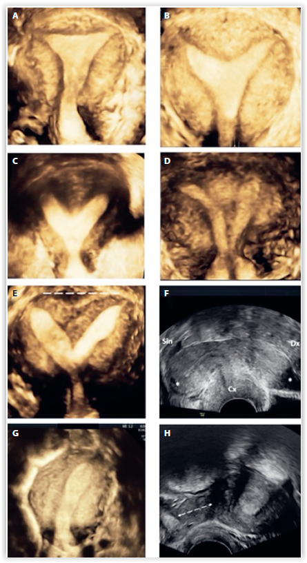 Kohdun synnynnäiset rakennepoikkeavuudet - onko niillä merkitystä?