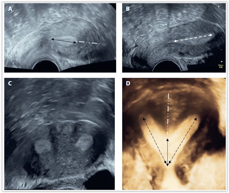 Kohdun synnynnäiset rakennepoikkeavuudet - onko niillä merkitystä?