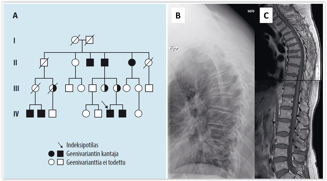 Perinnöllinen osteoporoosi