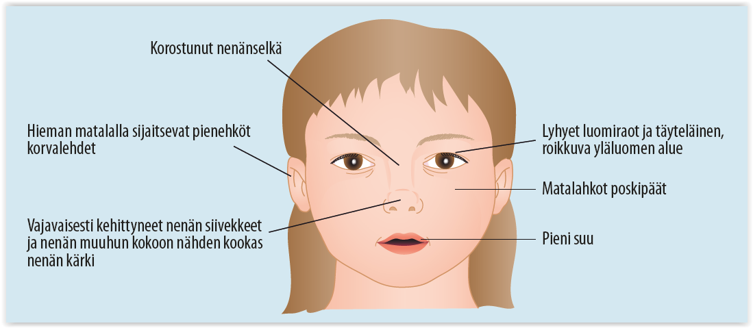 22q11.2-deleetio-oireyhtymän hoito ja seuranta