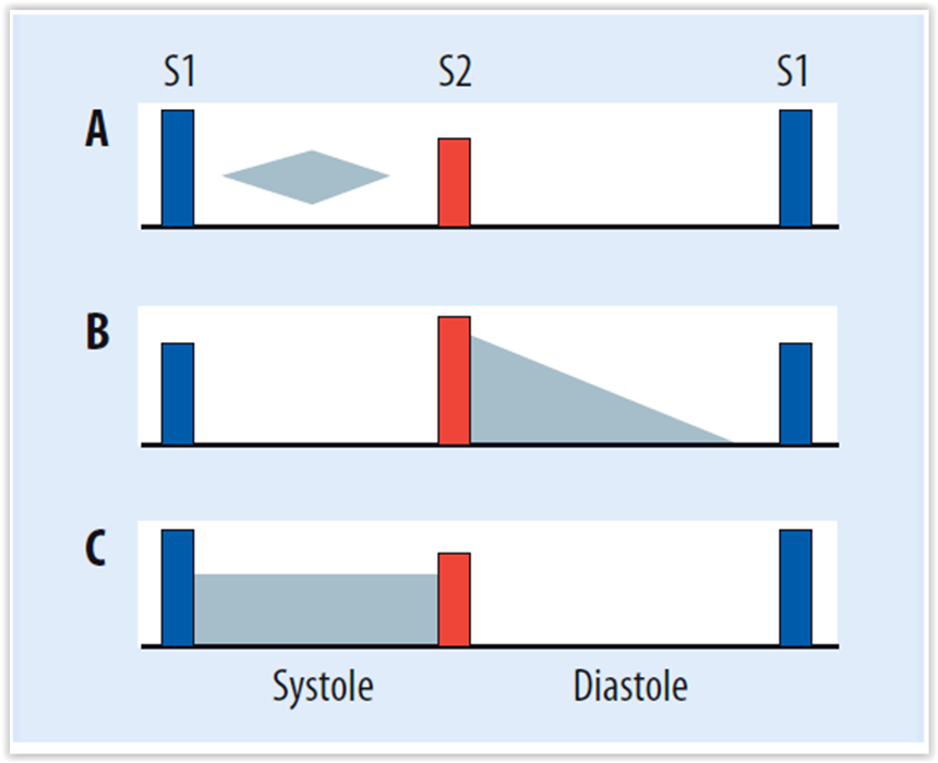 Lapsen sydämen sivuääni