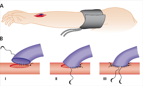 Veritiekirurgia - tekniikkaa ja tiimityötä
