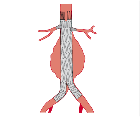 Aortta-aneurysman vaativa hoito muuttumassa