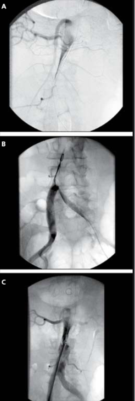 Päivystysongelmat verisuonikirurgiassa