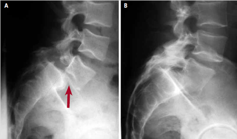 Kasvuikäisen selkäongelmien kirurginen hoito