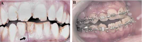 Epäilen kasvoluun murtamaa - mitä teen?