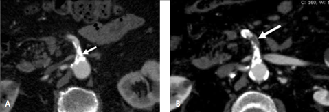 Mesenteriaali-iskemian diagnostiikka ja endovaskulaarinen hoito