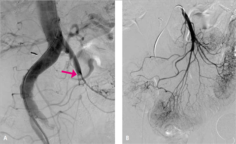 Mesenteriaali-iskemian diagnostiikka ja endovaskulaarinen hoito