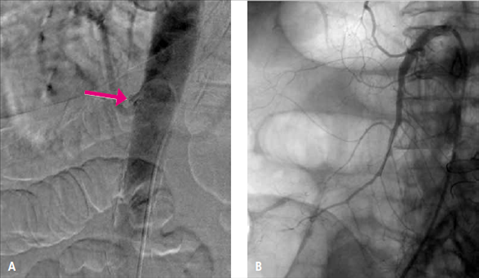 Mesenteriaali-iskemian diagnostiikka ja endovaskulaarinen hoito