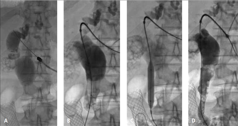 Maksan ja sappiteiden toimenpideradiologia