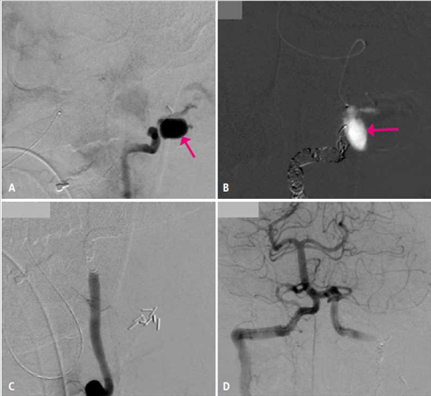 Vuotavan traumapotilaan diagnostiikka ja toimenpideradiologinen hoito