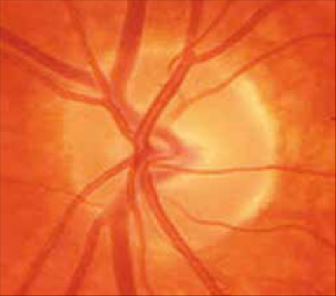 Näköhermon papillan tutkiminen