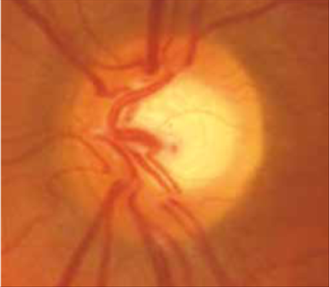 Näköhermon papillan tutkiminen